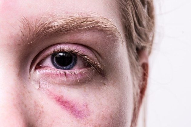Why do my tears burn my face? The unseen problems and their solutions ...