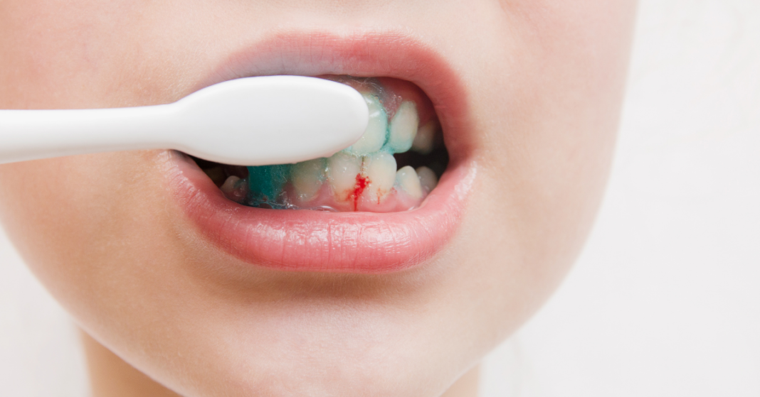 Bruise on Gums - Causes, Symptoms and Treatments! | Exercise Daily