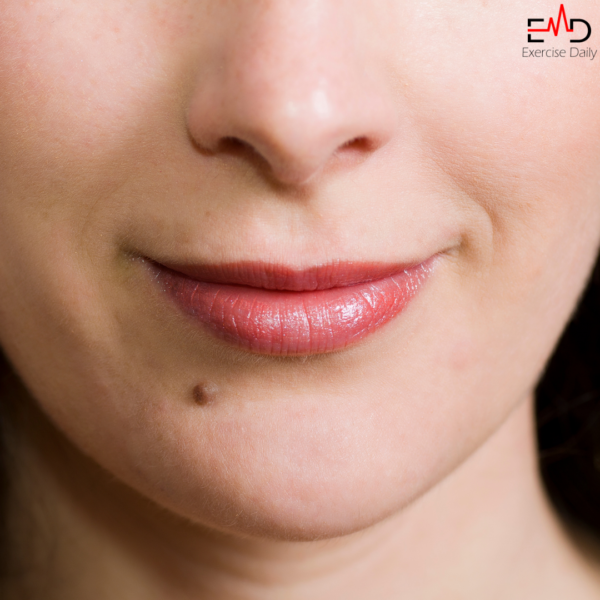 White Bumps on Lips - Causes and Management