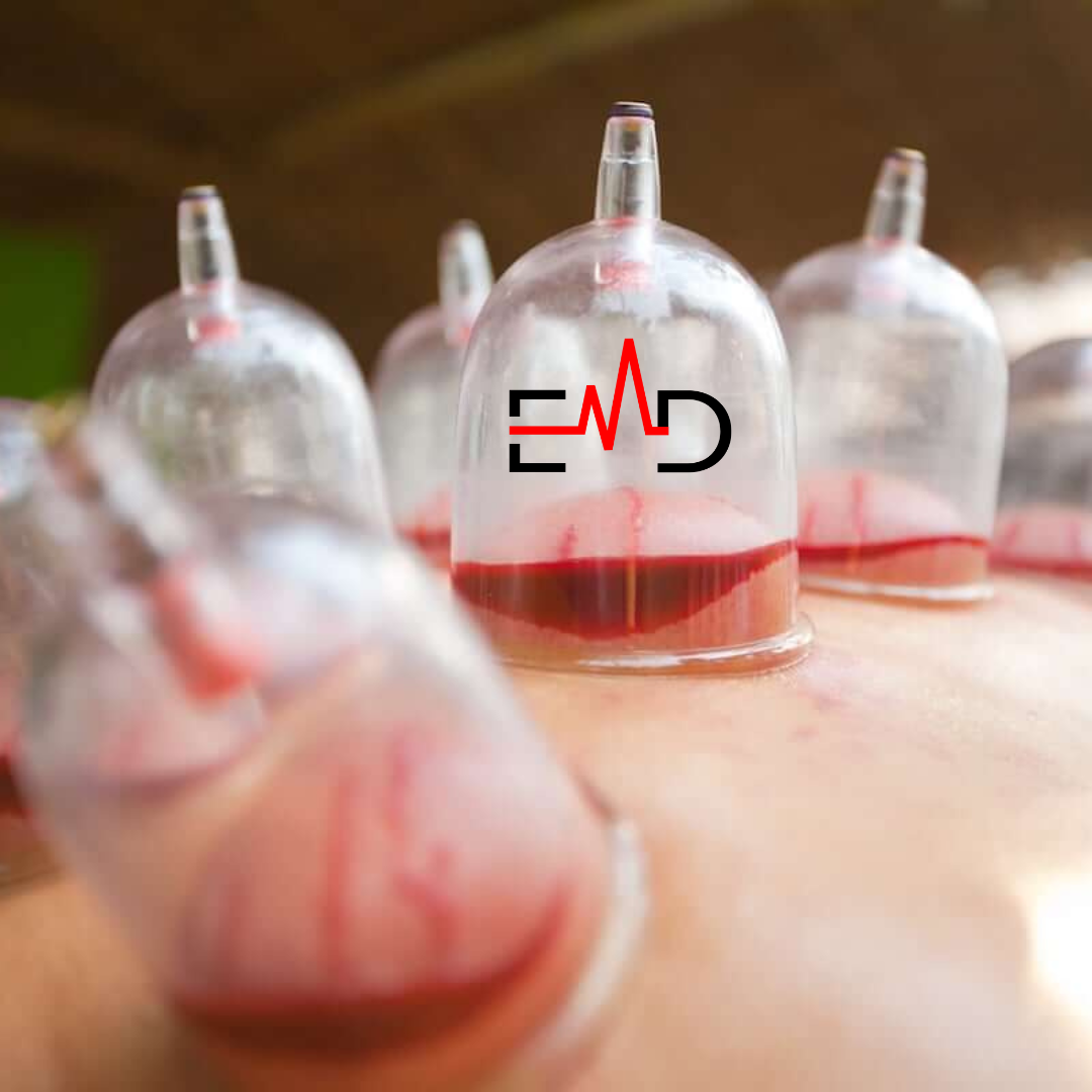 Wet Cupping Benefits A Natural Remedy for Pain and Inflammation
